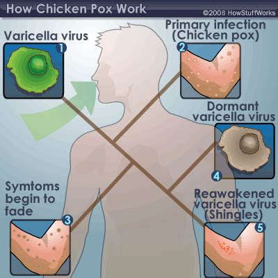 Spread And Transmission Chickenpox