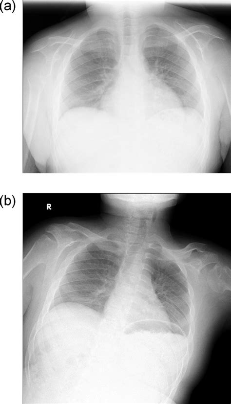 Bilateral Hypertrophy
