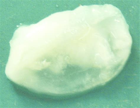 Excised Cyst Showing The Characteristic Pearly White Membranous