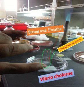 String Test Principle Procedure Result And Interpretation