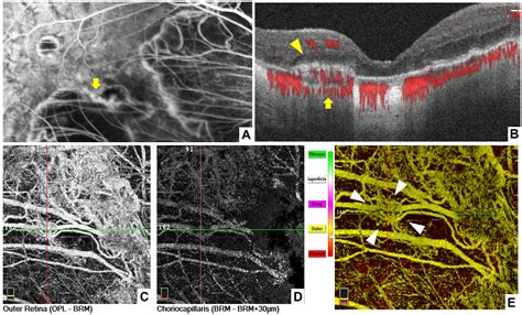 Video Color Oct Angiography For Myopic Choroidal Neovascularization Ophthalmology Retina
