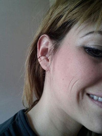 How To Get Rid Of Cheek Wrinkles Photo Doctor Answers Tips