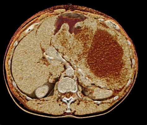 Ulcerating Gastric Gist Tumor Stomach Case Studies Ctisus Ct Scanning