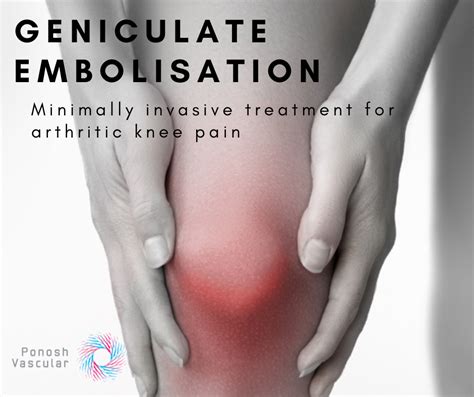 Geniculate Embolization Minimally Invasive Treatment Of Arthritic