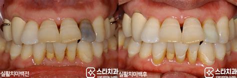 창원 마산 합성동 원데이 치아미백 스타치과 의원