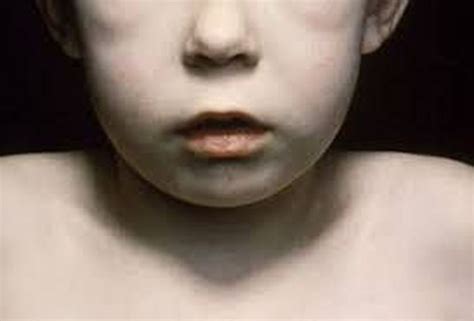 Glomerulosclerosis Symptoms Medizzy