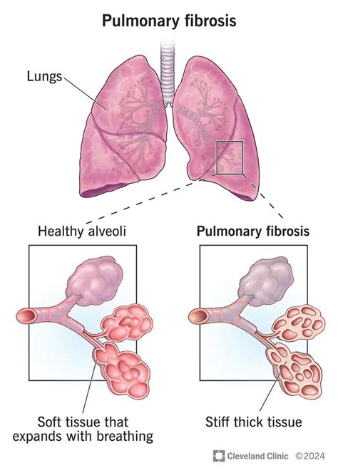 Cystic Fibrosis Lungs
