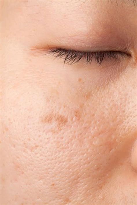 Sun Damage Effect Of Sun Exposure Skin Associates Of South Florida