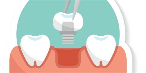 The Difference Between Full And Mini Dental Implants
