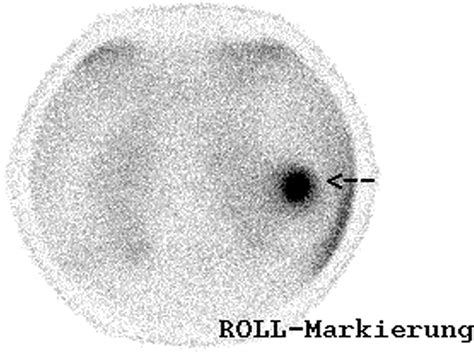 Radioguided Occult Lesion Localization Roll For Treatment And Diagnosis Of Malignant And