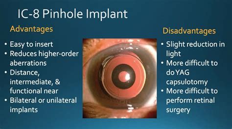 Update On Corneal Crosslinking And Topography Guided Prk In The Management Of Keratoconus