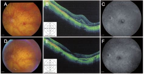 Female 78 Yrs 12 D With Metamorphopsia For 1 Week Prior To