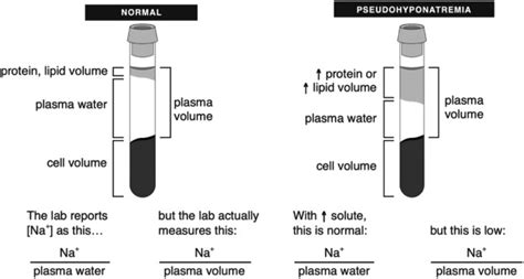 Pseudohyponatremia A Concise Guide To Diagnosis And Management In Clinical Practice The