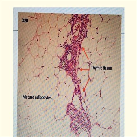A Good Surgical Exposure In A Clamshell Thoracotomy B The Clamshell