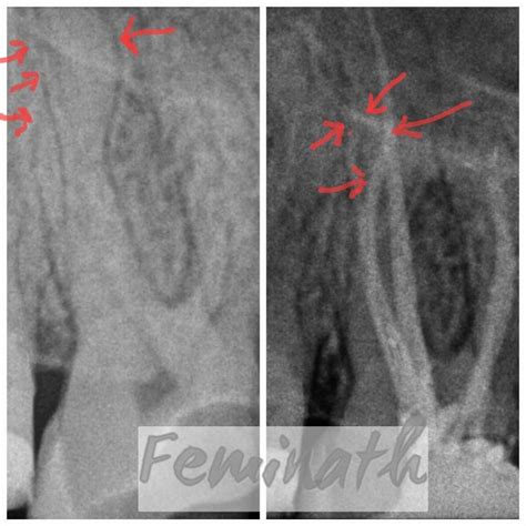 S Shaped Curve On A Distal 17 Done Using Hanudent Topflex Files With Ease Dr Feminath Gopinathan