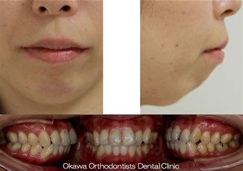 顎変形症 Jaw Abnormality Japaneseclassjp