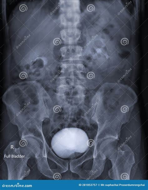 Intravenous Pyelogram Or Ivp Stock Image Image Of Colic Adrenal