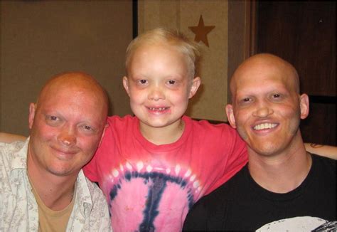 Anhidrotic Hypohidrotic Ectodermal Dysplasia Dermatology Advisor