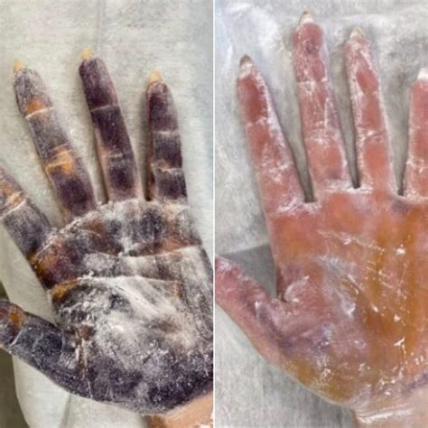 Лечение гипергидроза в Казани Beauty Season