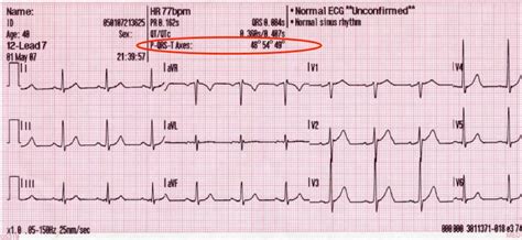 Cardiac Axis Deviation Ecg Interpretation Nurse Your Own Way