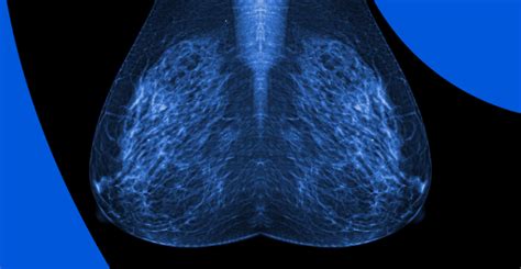 Mammograms And 5 Other Types Of Breast Screening Exams Pockethealth