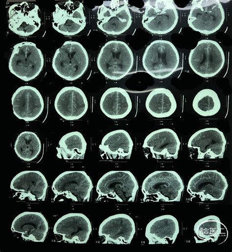 Time To Evolve 超越之旅 Surpass Evolve治疗外伤性假性动脉瘤一例及6个月随访 脑医汇