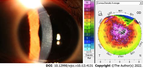 Diffuse Lamellar Keratitis