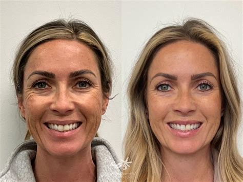 Botox Before And After Forehead