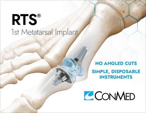The Reference Toe System® Is A Significant Leap Forward In Mtp Joint… Conmed Foot And Ankle
