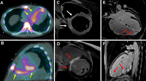Figure M Tc Pyrophosphate Scintigraphy PYP And Cardiac Magnetic Download Scientific