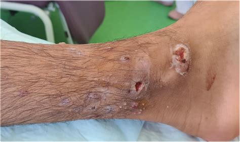 Reemergence Of Diphtheria In France Description Of 3 Cutaneous Cases