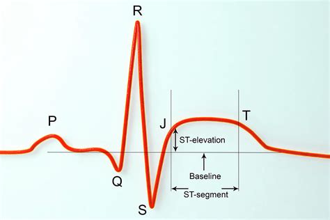 Anterior Myocardial Infarction Litfl Ecg Library
