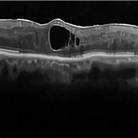 Intraretinal Cystoid Fluid Kaggle