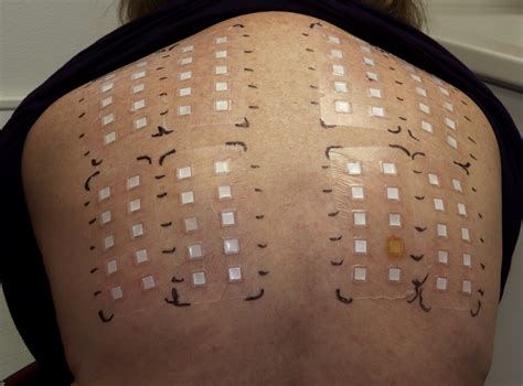 Allergy Patch Testing Dermatology Appointment In North Beach Maryland