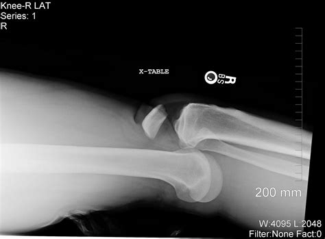 Knee Dislocation Trauma Orthobullets