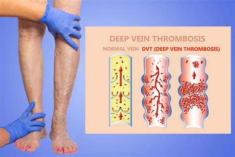 Deep Vein Thrombosis Dvt Prevention Awareness Month Signature
