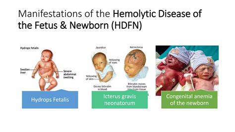 Manifestation Of Hdfn And Prophylaxis Of Rh Isoimmunization Pptx