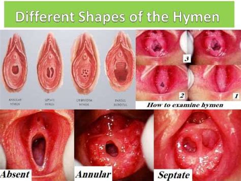 Hymen