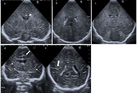 Coronal Ultrasound Scans A C Coronal Scans Through The Foramen Of