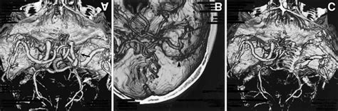 Preoperative Three Dimensional Computed Tomography Angiography 3d Cta