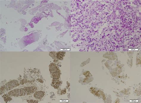 Pathology Results A Ebus Lymph Node Station 4r Fragments Of