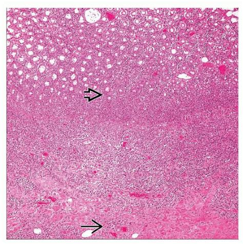 Large Cell Lymphoma Basicmedical Key