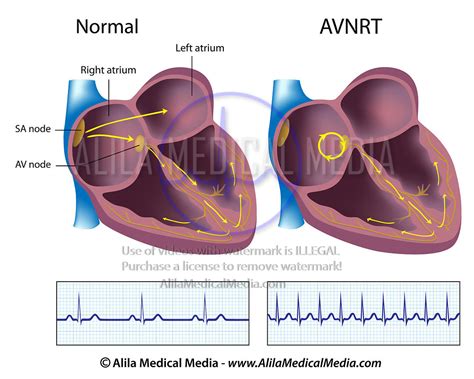 Alila Medical Media Avnrt Labeled Medical Illustration