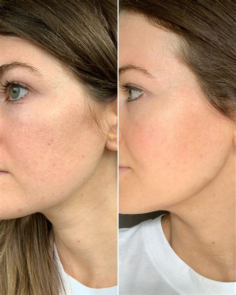 Face Stings After Retinol At Brayden Woodd Blog