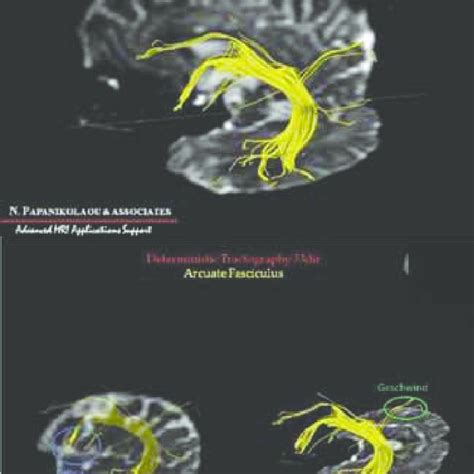 F Tractography Superior Longitudinal Fasciculus Part Of Which Is The Download Scientific