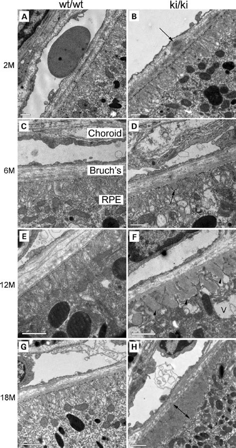 Basal Deposits And Rpe Vacuoles In Efemp1 R345w Mice Electron Download Scientific Diagram