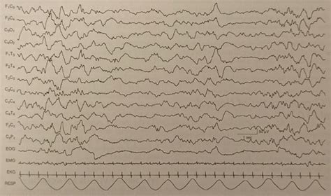 Neonate And Infant Normal EEG Images Flashcards Quizlet
