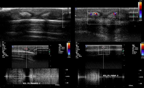 Sonographic Findings Small Solid Nodules In The Scalp Well Defined Download Scientific