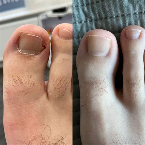 Toenail Removal Before And After