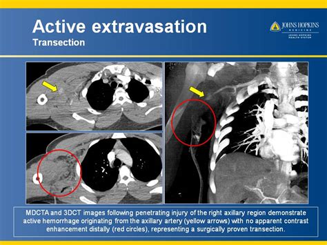 Active Extravasation Post Ctisus Cutting Edge Information On Body Ct Computed Tomography